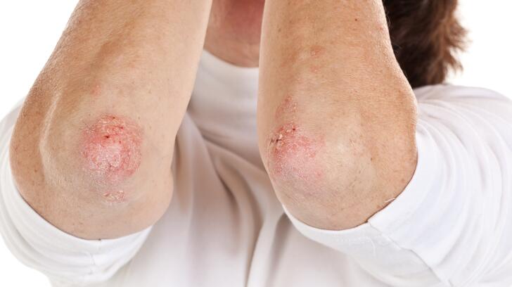 Psoriatic Arthritis Advice | 10 Things Specialists Want You to Know