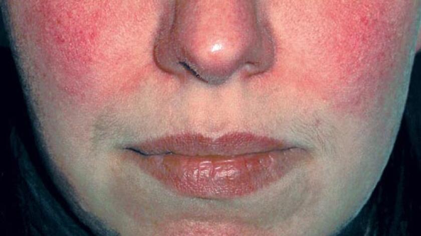 The Stages of Rosacea