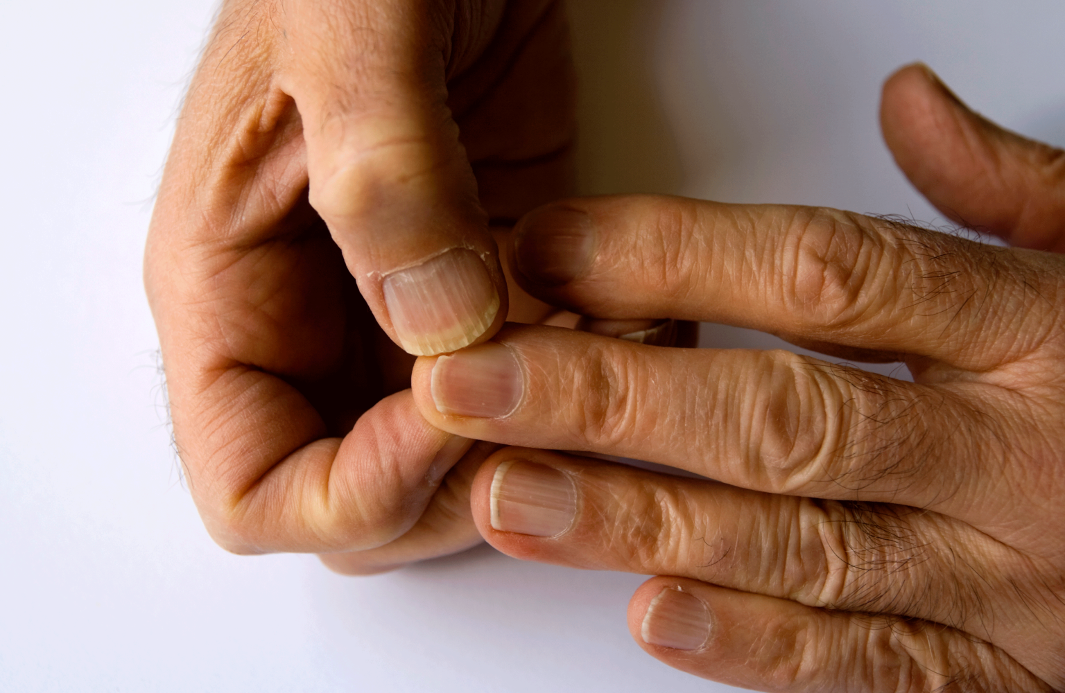 Que faire en cas d'infection des ongles | Traitement de la paronychie ...