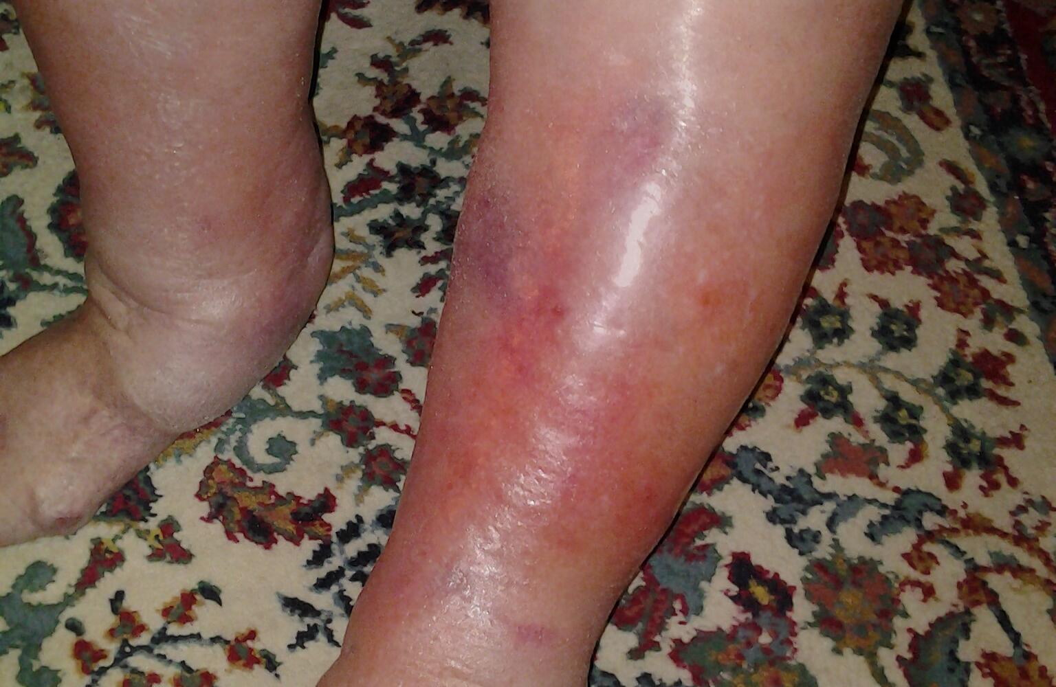 Cellulitis Causes Pictures And Treatment