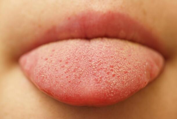 Swollen Tongue Symptoms Causes Treatments
