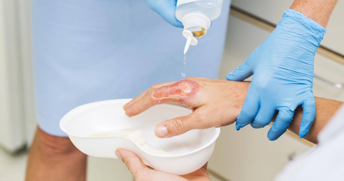 10 Things to Know About Burns | How to Treat 2nd and 3rd Degree Burns