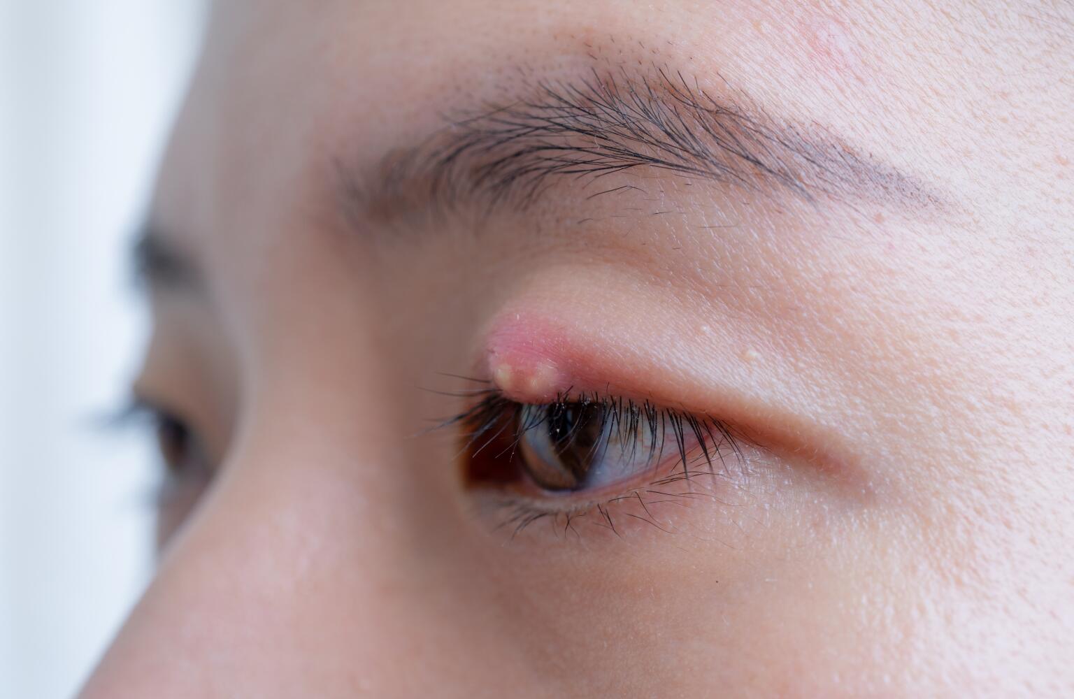 Abscess: Causes, Symptoms, Treatments & Complications