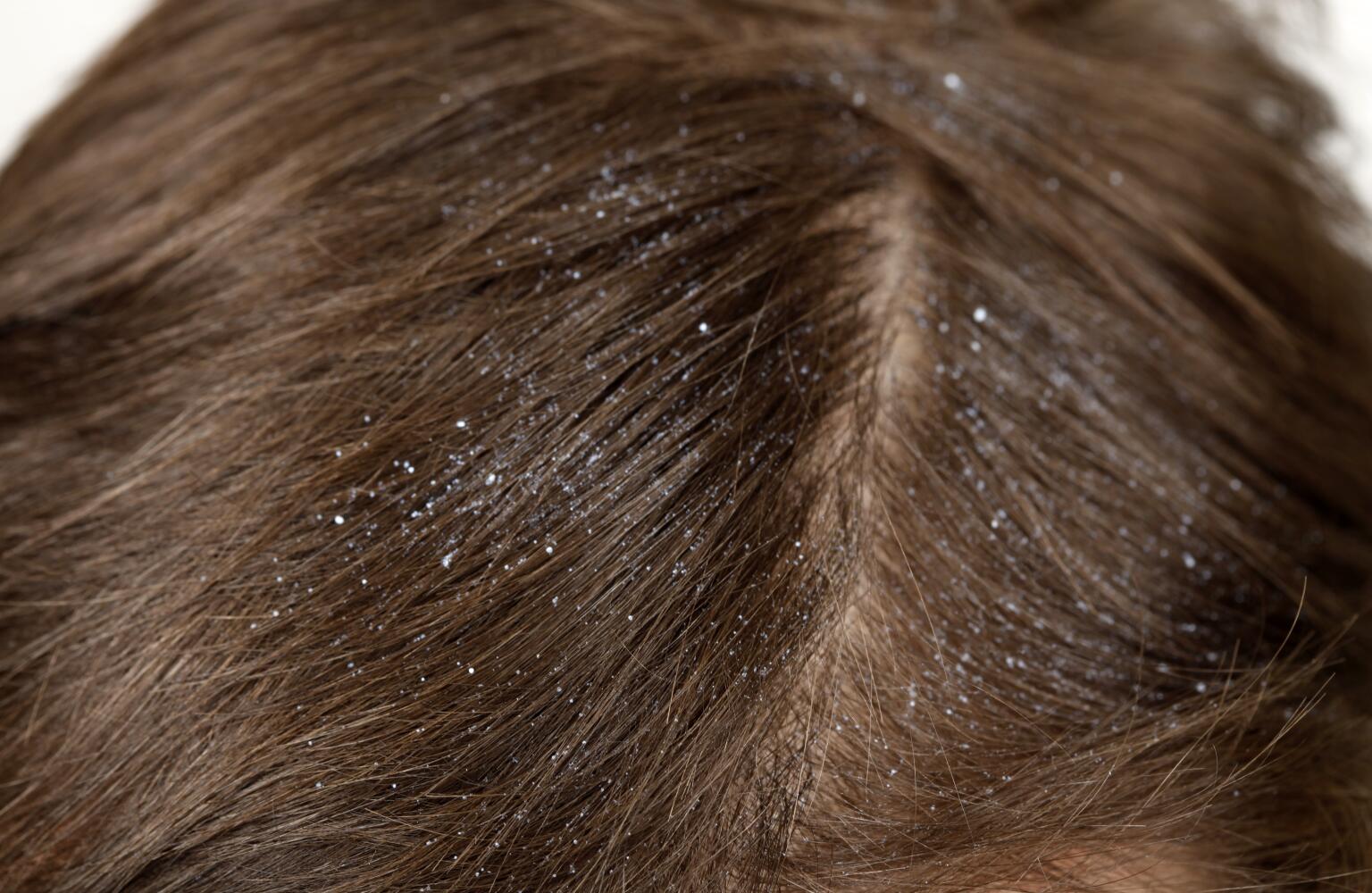 Frequently Asked Questions About Dandruff Causes & Treatment