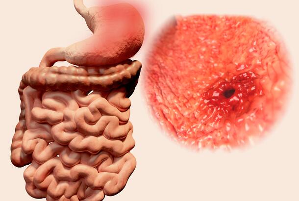 Gastric Ulcer - Symptoms, Causes, Treatments | Healthgrades.com